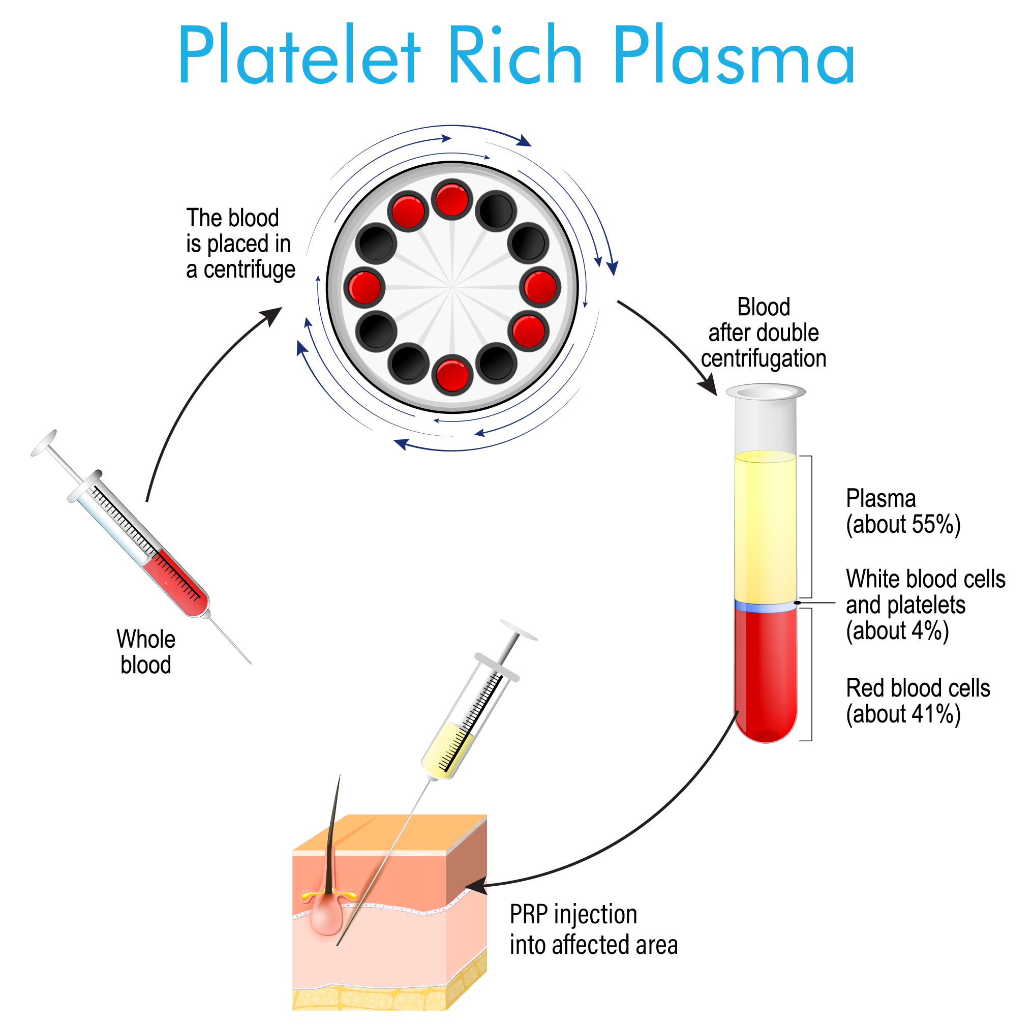 PRP (Platelet Rich Plasma) – Kochan Pain Treatment Center PRP (Platelet Rich Plasma) – Kochan Pain Treatment Center