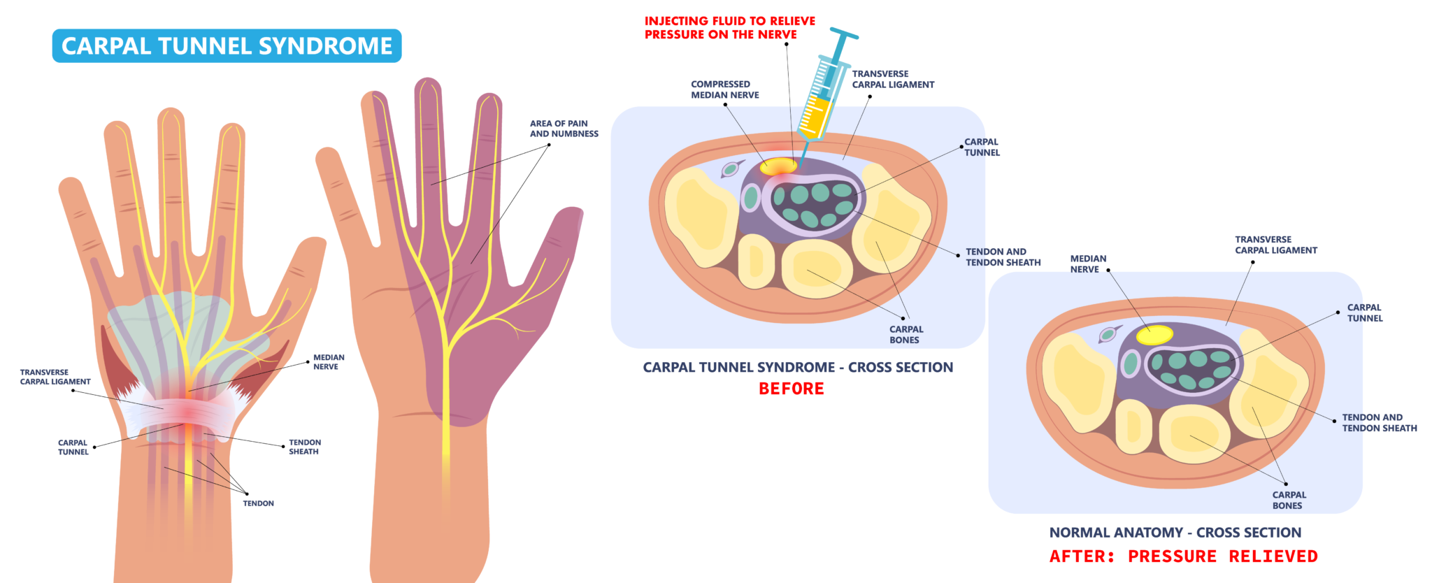 Hydrodissection – Kochan Pain Treatment Center